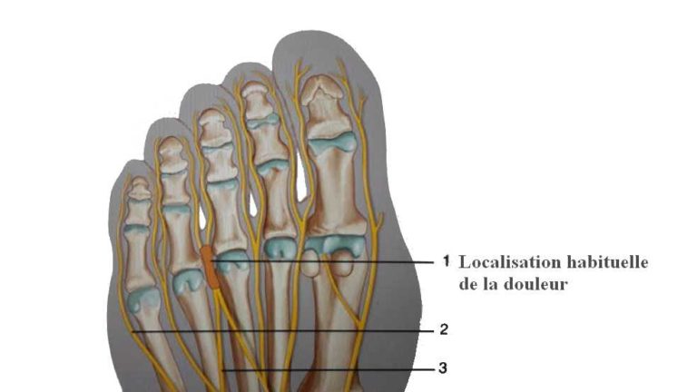Le syndrome de Morton • Podologue Anthony Carreira