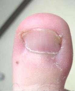 Ongle incarné - Causes et traitement - Anthony Carreira