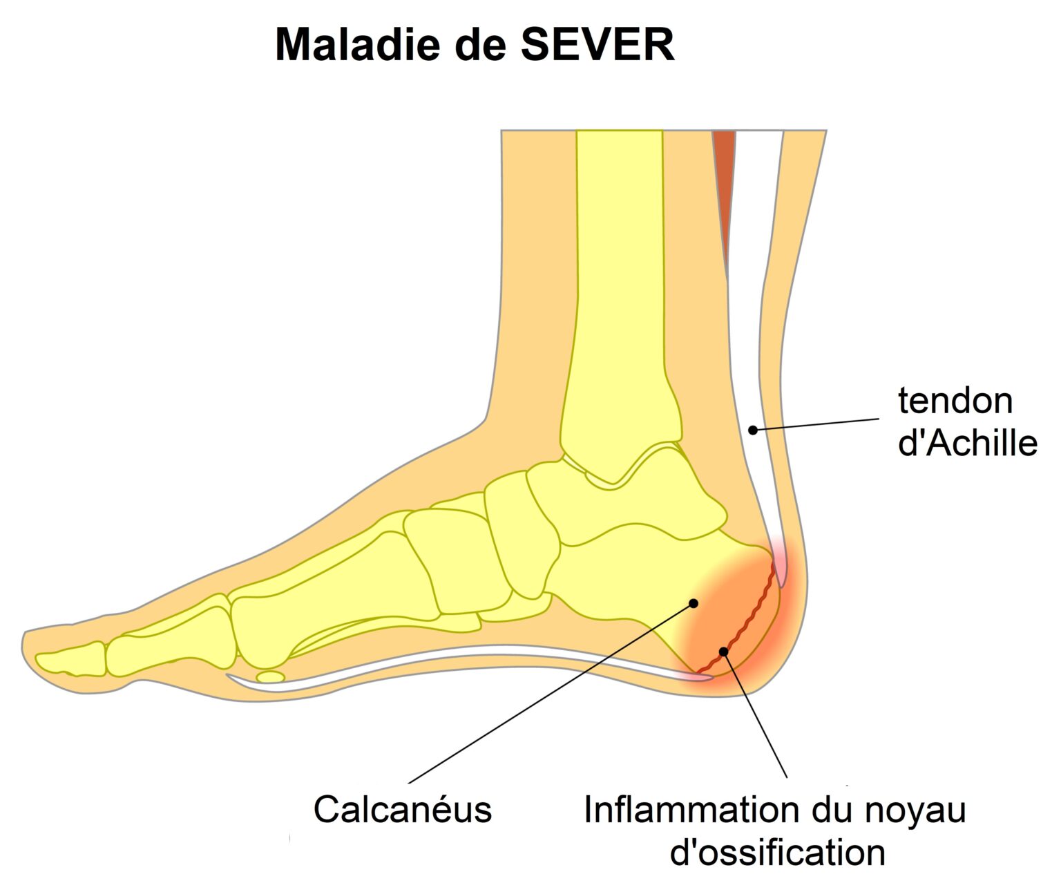 Maladie de Sever - douleur au talon chez l'enfant