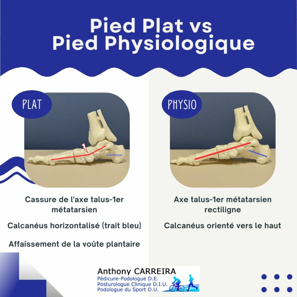 Semelle orthopédique et pied plat - un réel intérêt
